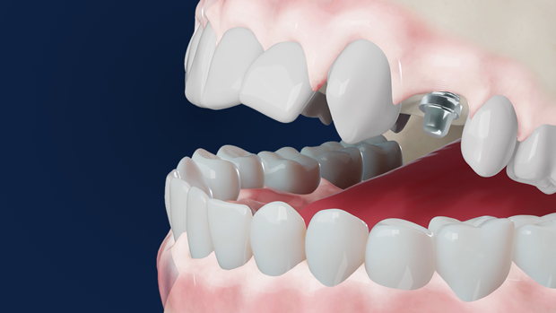 Dental Implants: A Long-term Solution for a Confident Smile - Stone ...